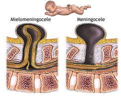Luciana Passos Fisioterapia e Pilates: MIELOMENINGOCELE