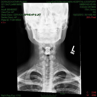 My Post Concussion Syndrome: 4 Weeks Post Op ACDF