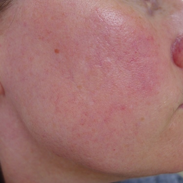 Rosacea, rosacea, bother this rosacea.: Still battling the demodex ...