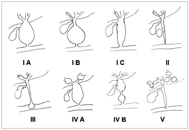 Radshare: CHOLEDOCHAL CYST