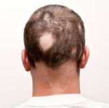 My Body Signs: Spotty or Patchy Hair Loss