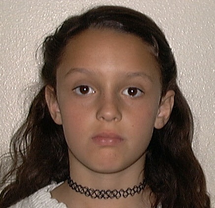 Truman Orthodontics: Unilateral Crossbite With a Functional Shift