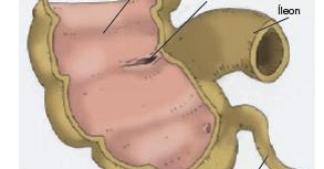 Unidad V - Abdomen, Intestino grueso ~ TúResumenMedStudent 2.0