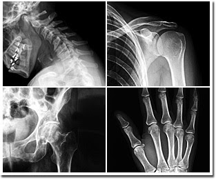MEDICINA: POLITRAUMATISMO