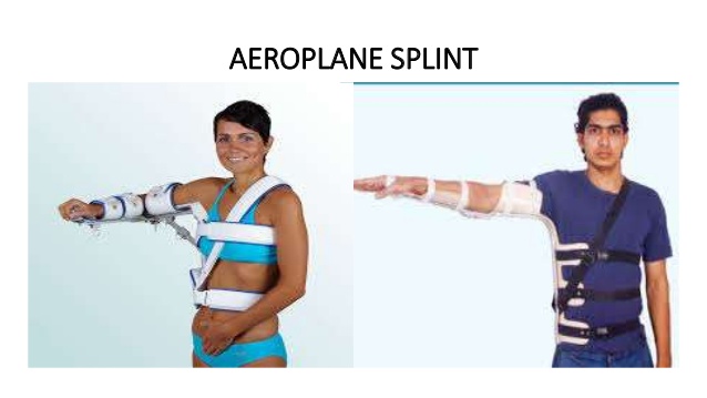 Aeroplane Splint - DNB Orthopaedics MS Orthopedics MRCS Exam GUIDE ...