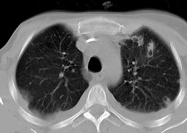 O Radiologista: Pneumatoceles