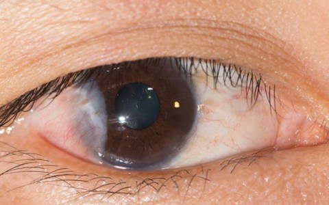 Penawar Penyakit Dan Masalah Mata: May 2018