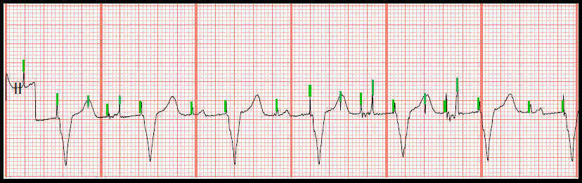 Basic EKG Rhythm Test 28