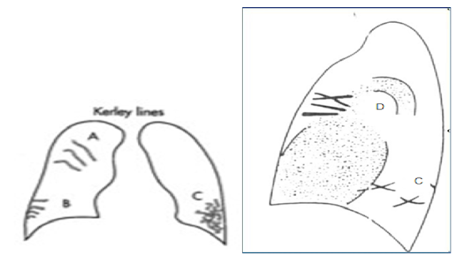 học Y: các đường Kerley A, B, C, D