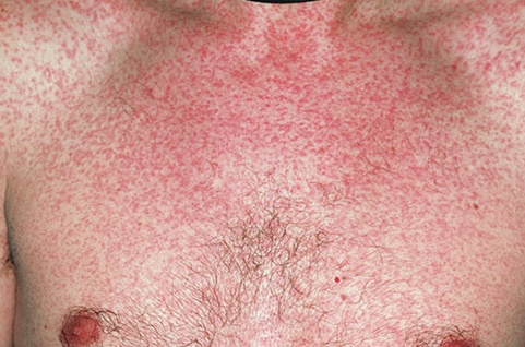 Understanding and complications of measles - Families