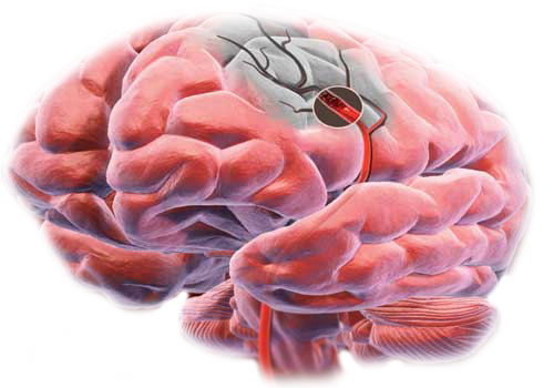 Enfermedad Vascular Cerebral (EVC): Generalidades del EVC