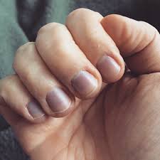 Cyanose// - Acute Zorg Blog