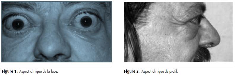 Orbitopathie endocrinienne d’origine thyroïdienne