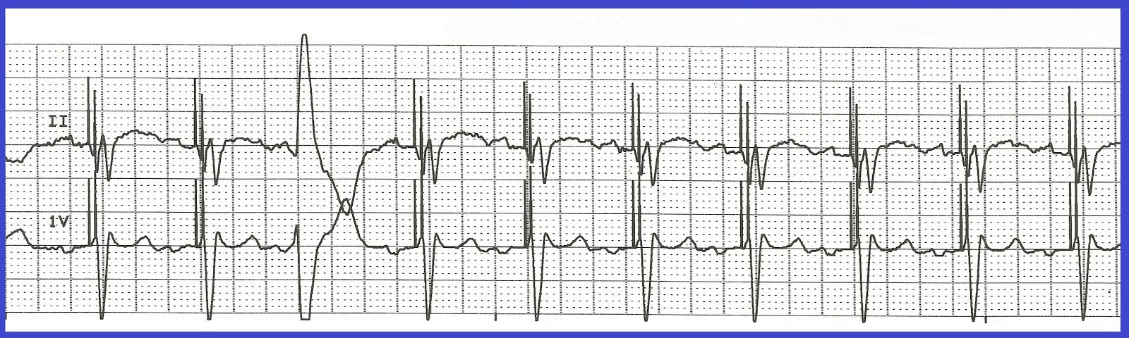 EKG Rhythm Strip Quiz 164