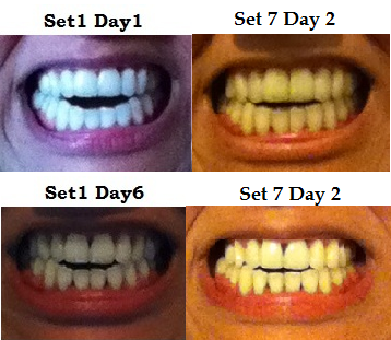 Invisalign For Severe Anterior Open Bite - My Pictures and Story: Tray ...