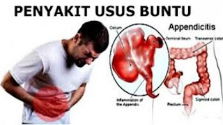 Beberapa Penyebab Usus Buntu - Eka Aprilya