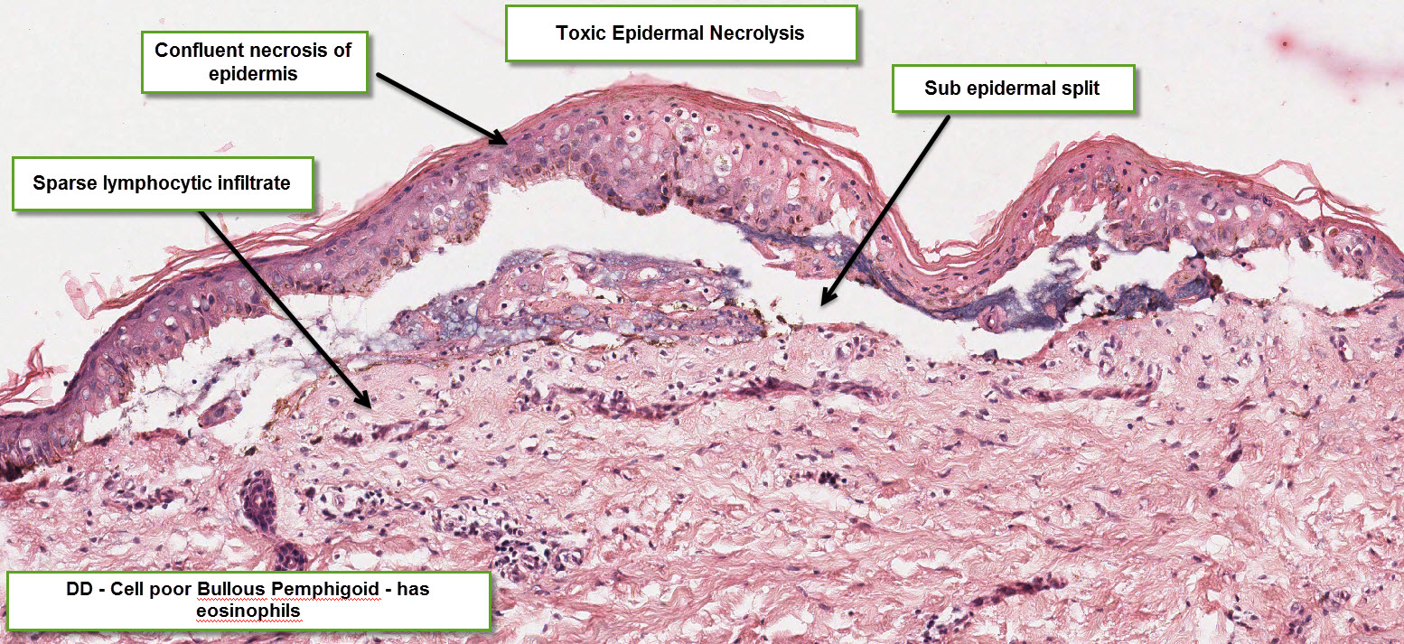 Dermatopathology Made Simple - Inflammatory: Interface - Vacuolar ...