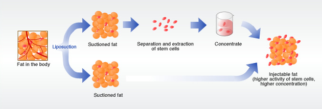 Dr. Lee Breast augmentation Korea: Perception on fat and stem cell ...