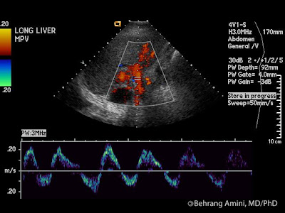 Roentgen Ray Reader: Portal Vein Pulsatility