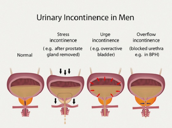 Medical Tourism in India | Medi Mantra Healthcare: Best urology ...
