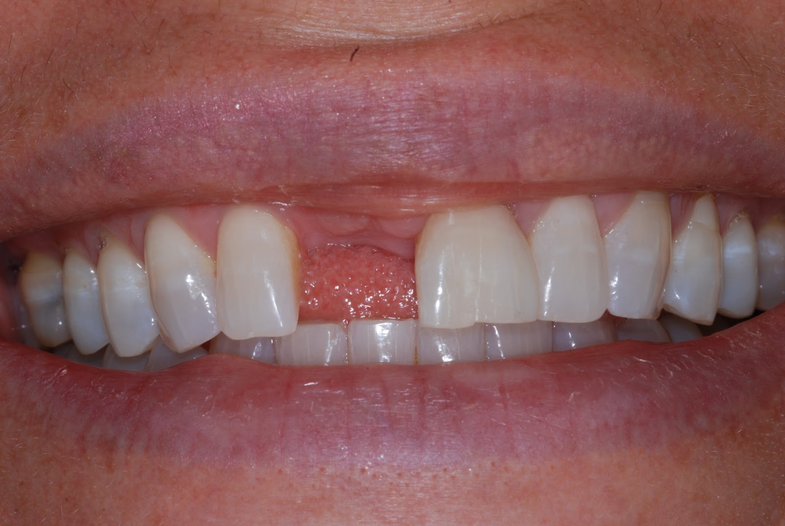 Sciascia Dental: Dental Implants -- The Natural Tooth Replacement