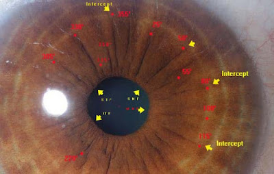 Modern & Multidimensional Iridology: Pupil Applanations, Schwalbe's ...