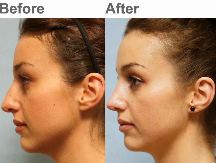 Facial Plastic Surgery: Cosmetic rhinoplasty, Dorsal hump, Tip rotation