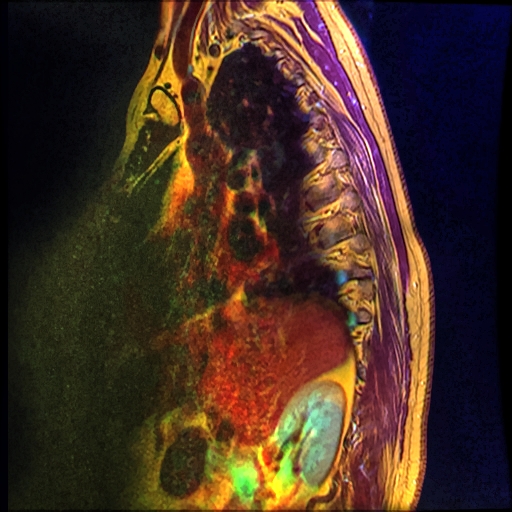 Nevit's blog: Dorsal Spine Color MRI