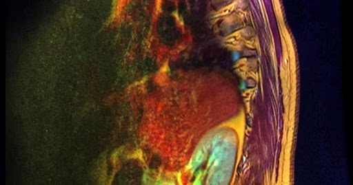 Nevit's blog: Dorsal Spine Color MRI