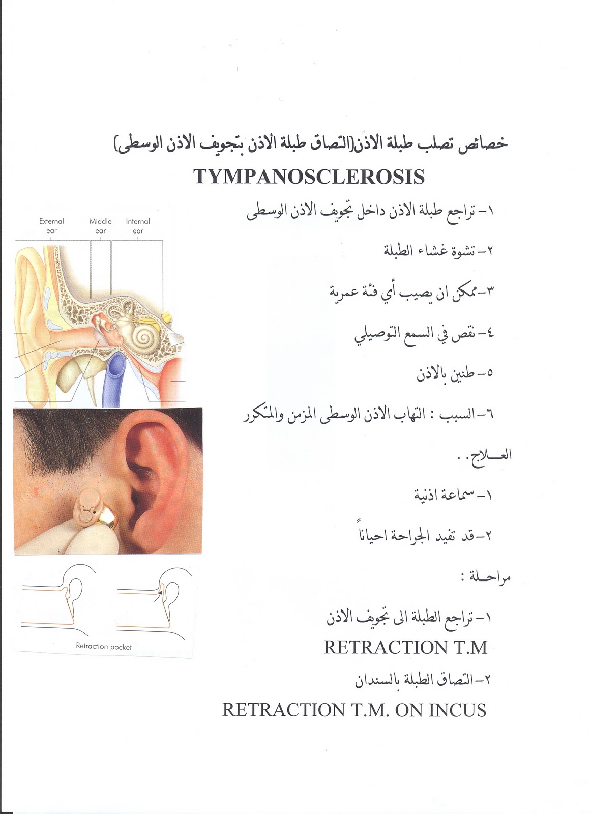 المدونة الطبية د.فهيد سالم السبيعي: تكلس طبلة الاذن TYMPANOSCLEROSIS