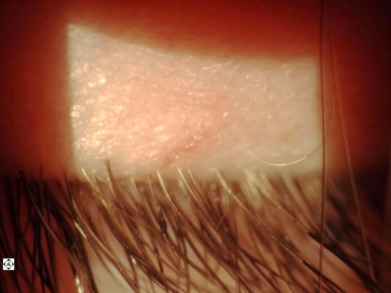 Sonoran Desert Eye Center: INGROWN EYELASH