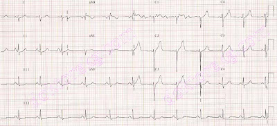Phimaimedicine: 1,288. Left posterior hemiblock