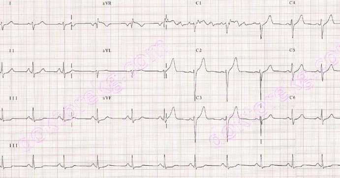 Phimaimedicine: 1,288. Left posterior hemiblock