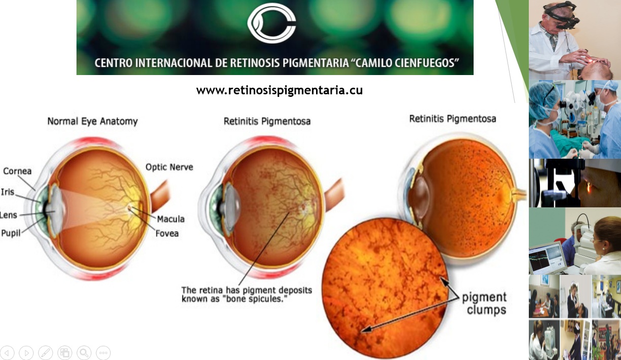¿Es la Retinosis Pigmentaria sólo una afección ocular? - Por Una Visión ...