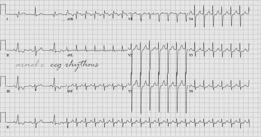 ECG Rhythms: Orthodromic AV Reentry Tachycardia