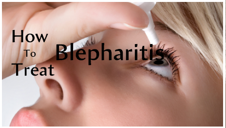 How to Treat Blepharitis - Healthy Eyes