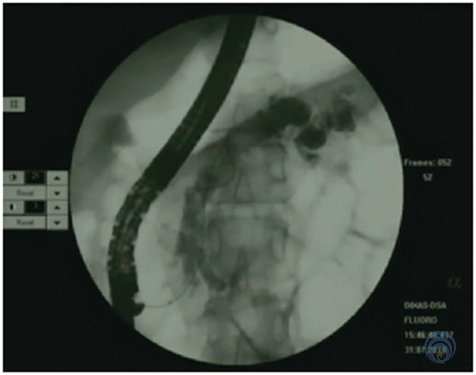 Endoscopy Asia Blog: Endoscopy Asia successfully treats a patient ...