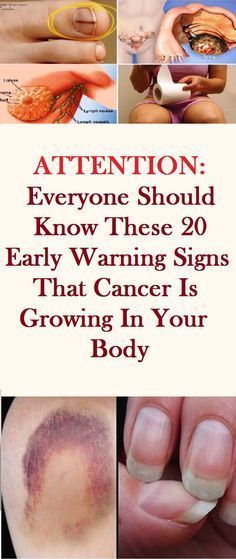 20 Early Warning Signs that Cancer is Growing in Your Body - HEALTH ROOTS