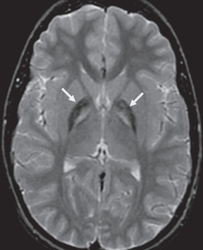 Medical Treatment Pictures-for Better Understanding: Hallervorden-Spatz ...