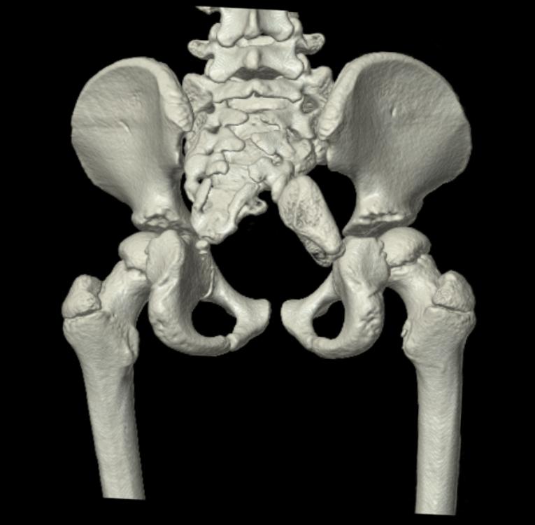 整形外科医のための英語ペラペラ道場: Sacral Rib