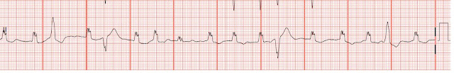 EKG Rhythm Strips 33
