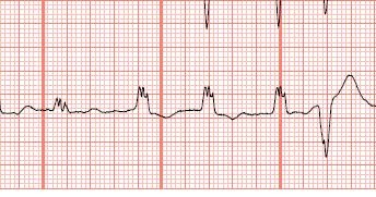 EKG Rhythm Strips 33