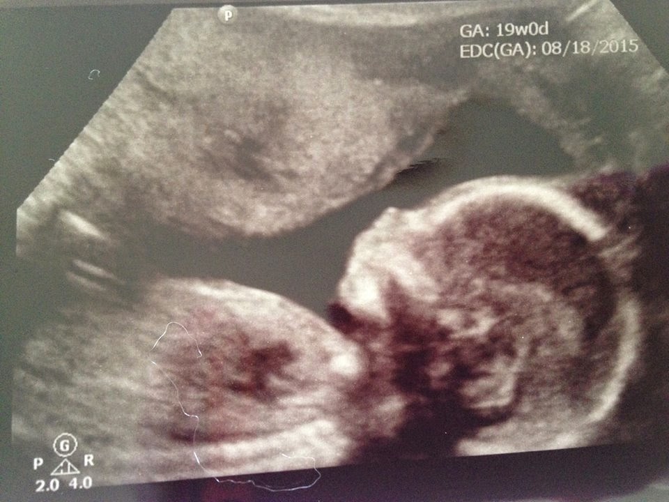 Anatomy Scan: 19 Weeks | Bad Cook, Great Baker