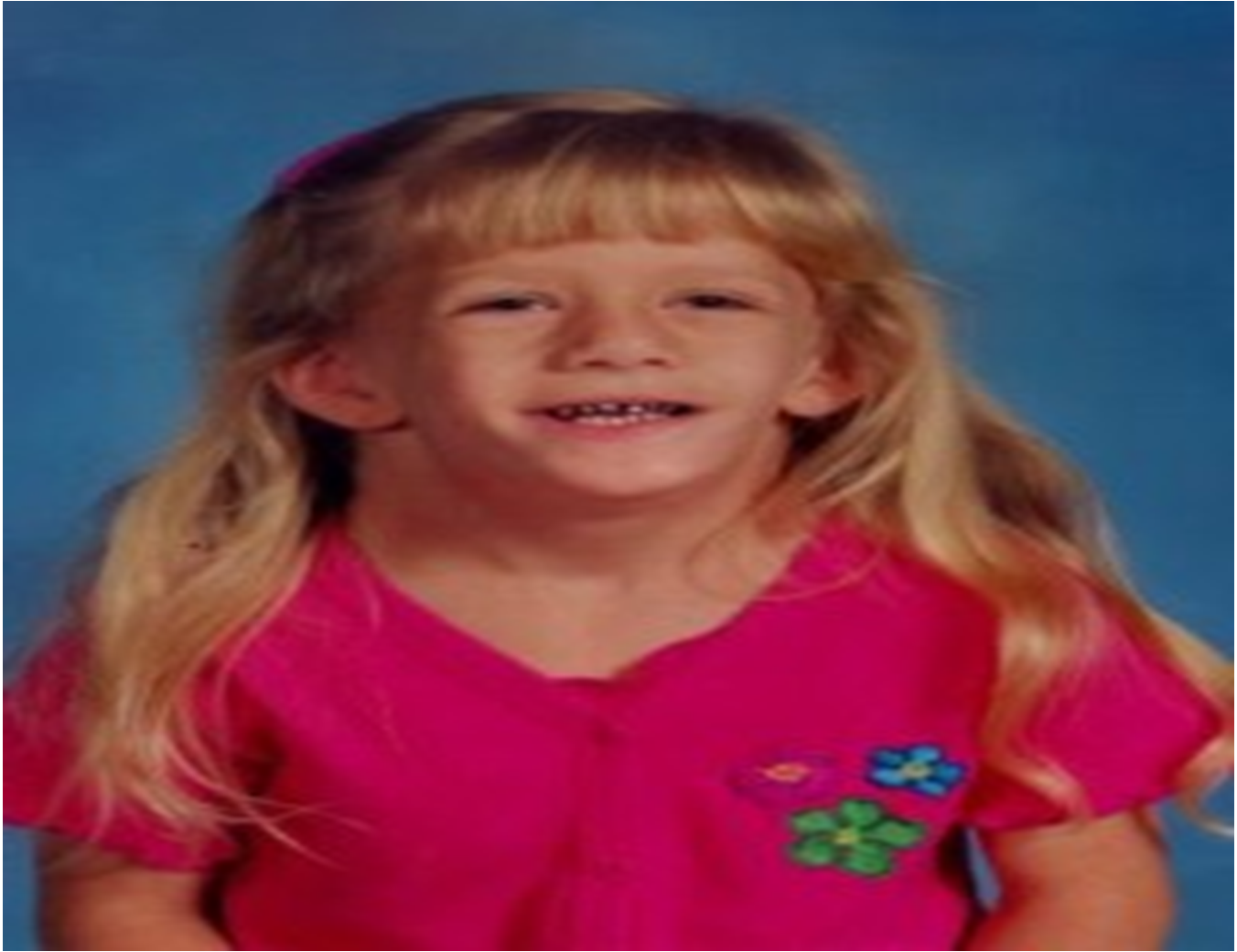 Síndromes : Síndrome de Turner