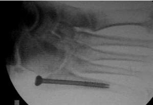 The Foot and Ankle Tribune: NFL reciever Nicks may return to line up ...