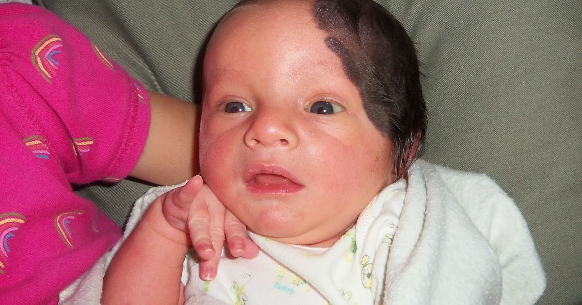 Tissue Expansion 101: My Giant Congenital Melanocytic Nevus