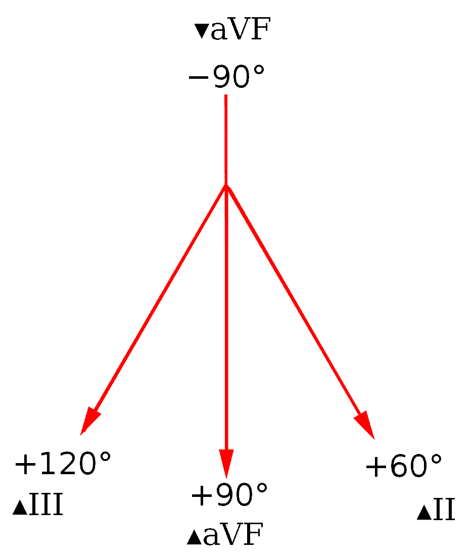 Блог по клинической электрофизиологии: Отведение aVF