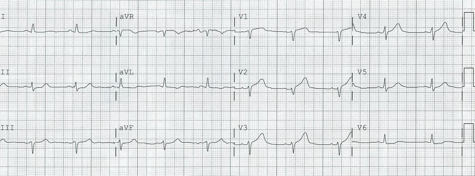 Dr. Smith's ECG Blog: Serial ECGs confirm initial suspicion of anterior ...