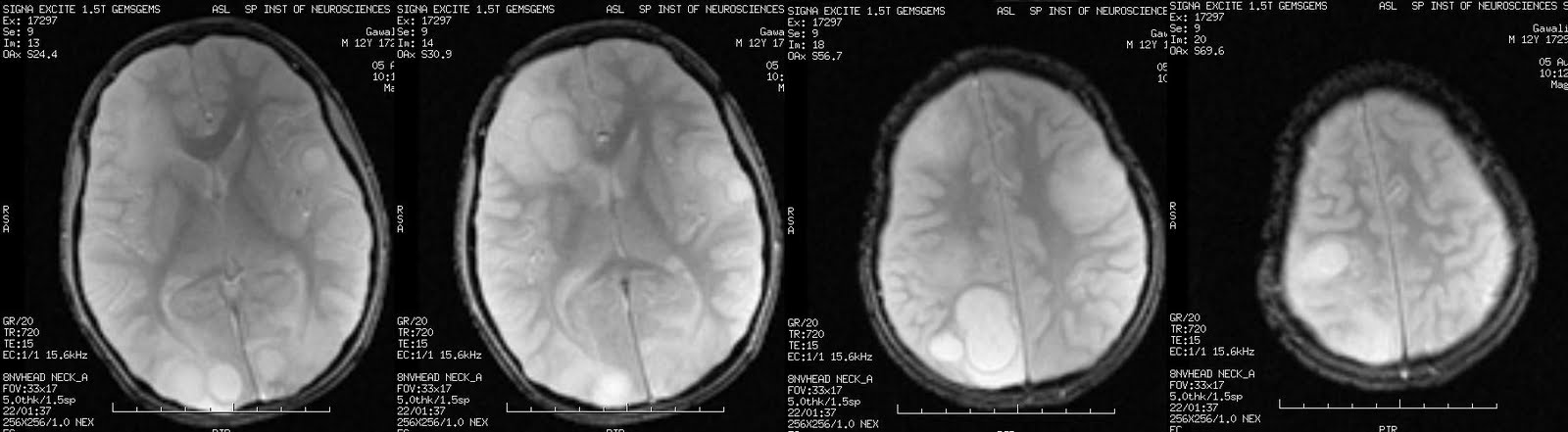 Dr Balaji Anvekar Frcr Multiple Ring Enhancing Lesions In Brain