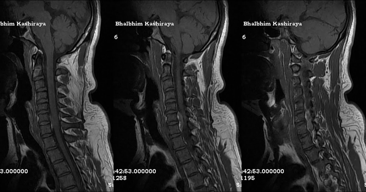 Dr Balaji Anvekar FRCR: Spinal Epidural lesion MRI